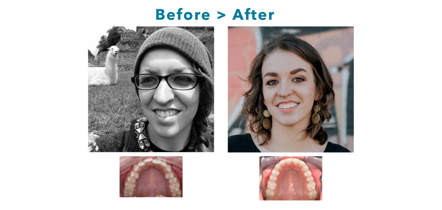 From Self-Conscious to Confident Smile with Clear Aligners - Blue Ridge ...