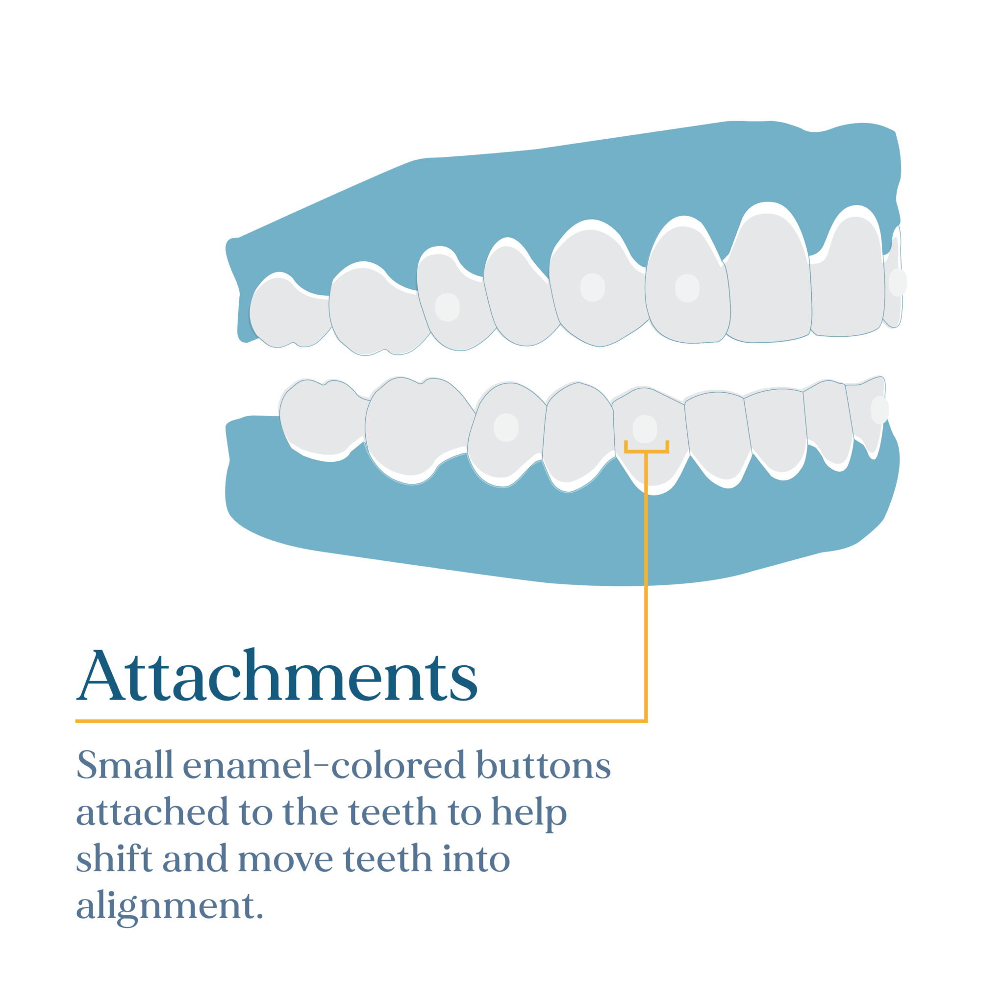 Clear Aligners | Teeth Straightening Treatment | At-Home Aligners